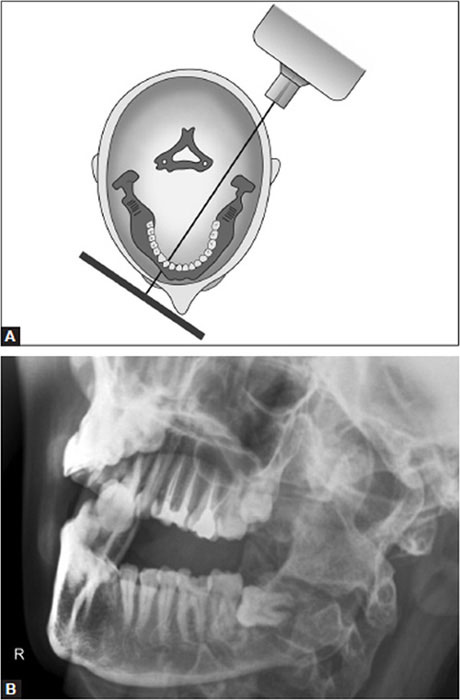 Oblique Lateral Mandible Radiograph