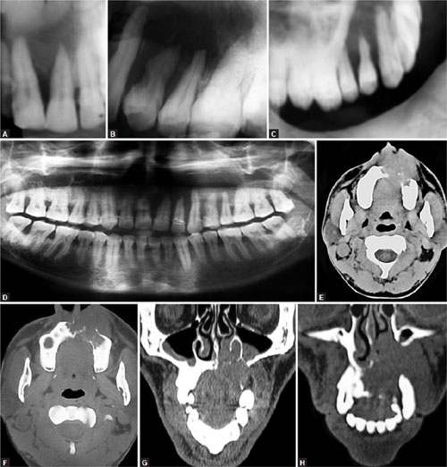 Submandibular Fossa Dental X Ray