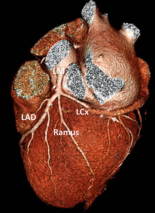 Coronary Artery Anatomy Ramus