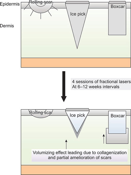 Fractional Photothermolysis A New Therapeutic Modality Laser Skin