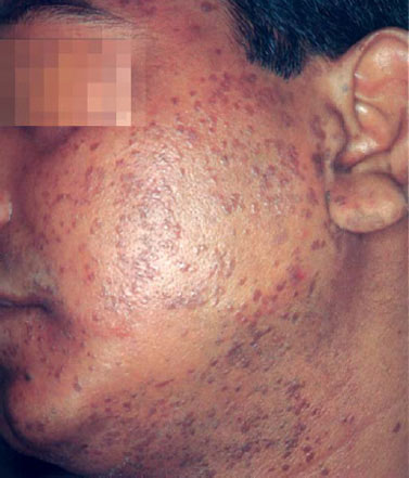 Erythrasma Face