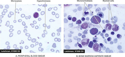 Bone Marrow Smear Labeled