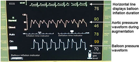 Intra Aortic Balloon Pump Waveform