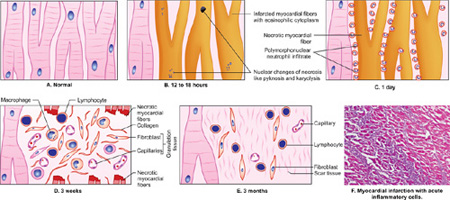 Myocardial Infarction Histology Labelled Diagram
