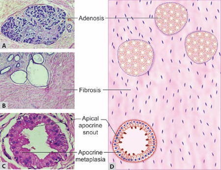 Apocrine Metaplasia