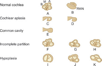 Figure 1 From There Is Something In The Ear Mondini Dysplasia