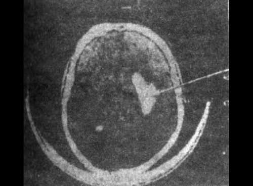 Quadrantenanopsie Icd