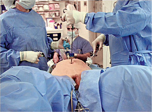 Dorsal Lithotomy Position Hysterectomy