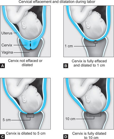 Dilated Cervix During Labour