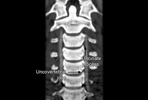 Uncinate Process Vertebra Radiology