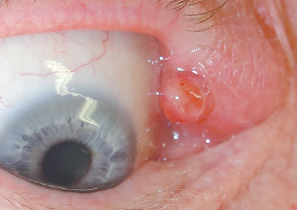 Canaliculitis Eye Treatment