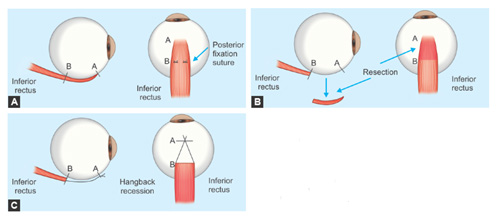 Comparative Study Of Y-Split Recession Versus Faden, 60% OFF