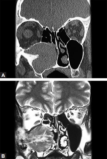 Inverted Papilloma Mri