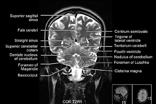 Foramina Of Luschka Radiology