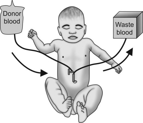 Exchange Transfusion Diagram Anaphylactic Transfusion Reaction