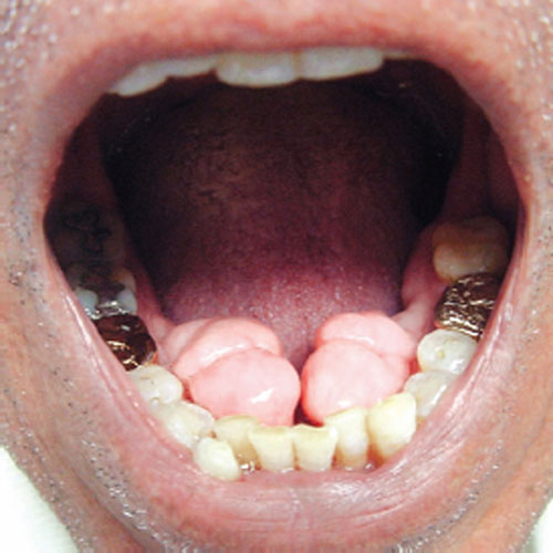 Unilateral Torus Mandibularis