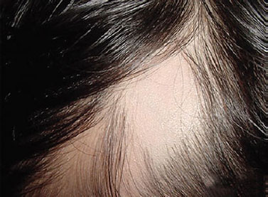 Acquired Canities