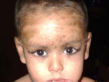Ichthyosis Vulgaris Face