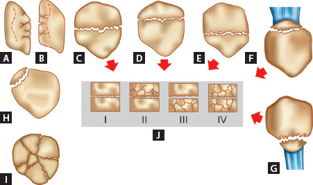 Patella Fracture Classification Floating Knee Injuries In Adults And
