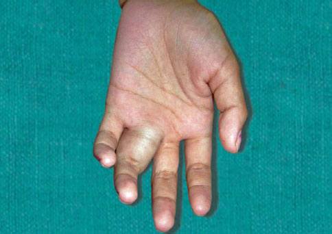 Hand Venous Malformation JaypeeDigital | EBook Reader