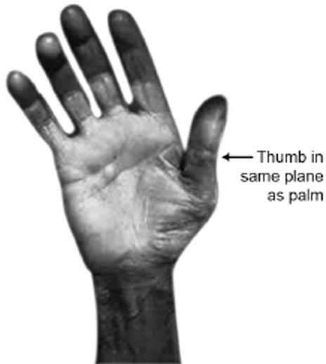Ape Hand Deformity Median Nerve