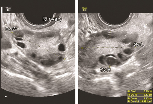 Figure From Updated Ultrasound Criteria For Polycystic, 55% OFF