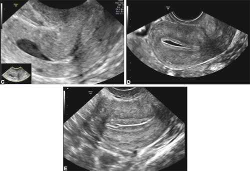 The Fluid In Uterine Cavity