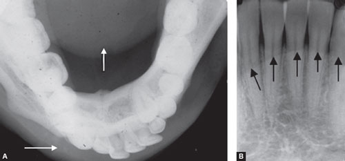 Submandibular Fossa Dental X Ray