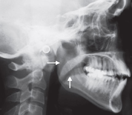 Hamular Process Radiopaque Or Radiolucent