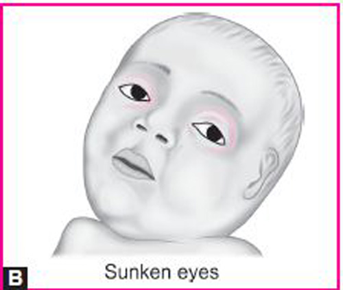 Sunken Eyes In Babies