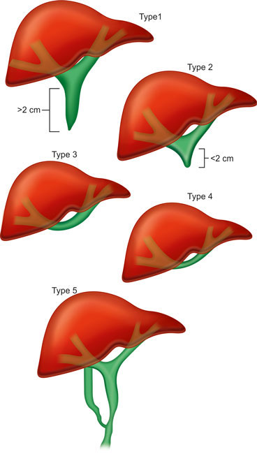 Common Hepatic Duct Stricture