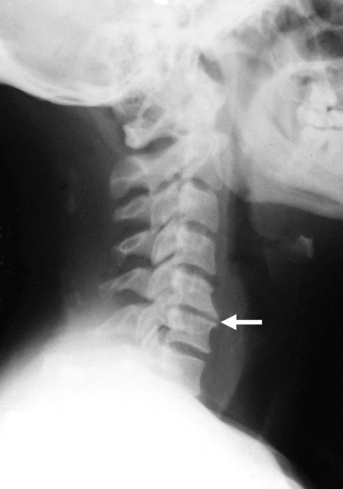 Anterior Lipping