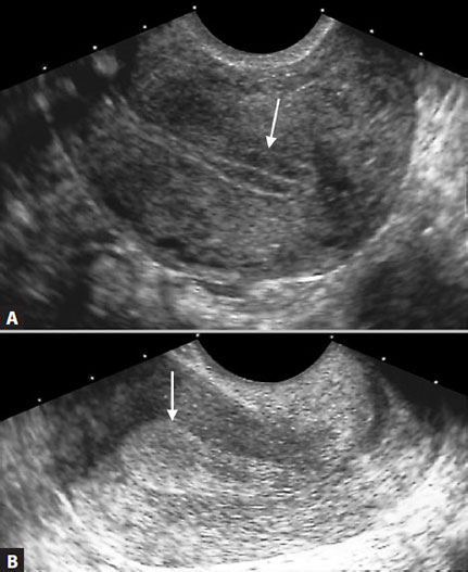 Phases Of Endometrium On Ultrasound Making The Diagnosis With