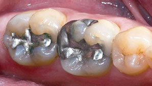 amalgam restoration stains