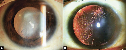Necrotizing Interstitial Keratitis
