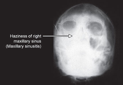 X Rays In Ent Anomaly Detection In Chest X Rays Based On