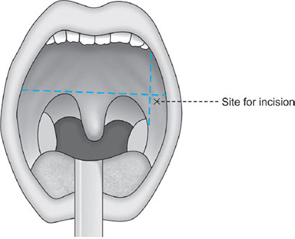 Peritonsillar Abscess Incision And Drainage