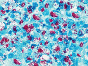 Micrococcus Acid Fast