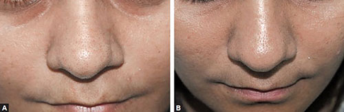 Trichostasis Spinulosa Causes
