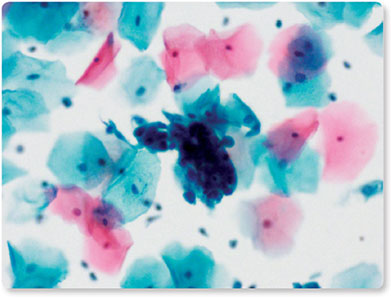 Normal Endometrial Cells Cytology
