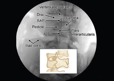 Sacral Foramen Fluoroscopy