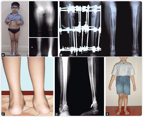 Fibular Hemimelia Diagram