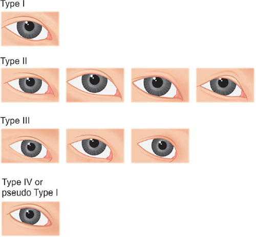 Epicanthic Fold Types