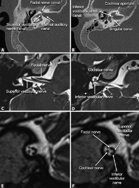 Vestibular Nerve Mri Anatomy