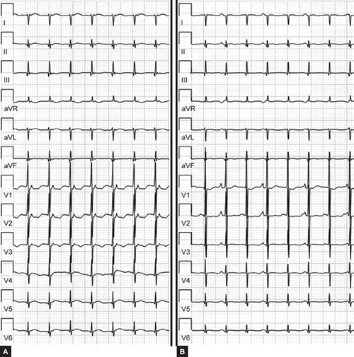 Junctional Ectopic Tachycardia Ecg