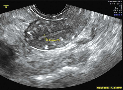 Arcuate Arteries Uterus Ultrasound