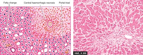 Chronic Venous Congestion Of The Spleen Histopathology