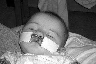 [아동간호학] 고위험 신생아의 선천적 안면장애(구순열/구개열) : 네이버 블로그