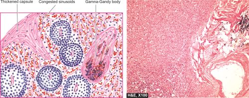 Chronic Venous Congestion Of The Spleen Histopathology