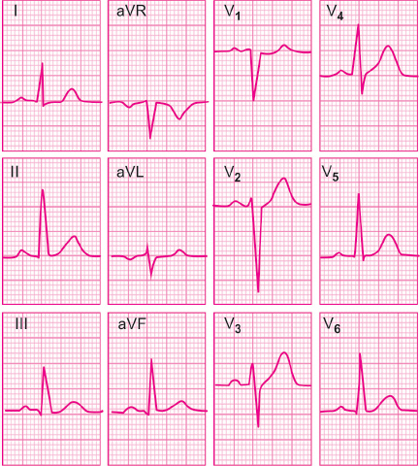 Normal 12 Lead Ecg